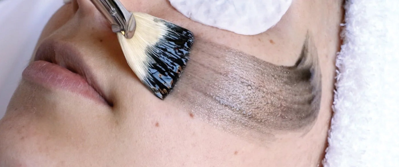 What To Expect After A Chemical Peel: Everything You Need To Know ...