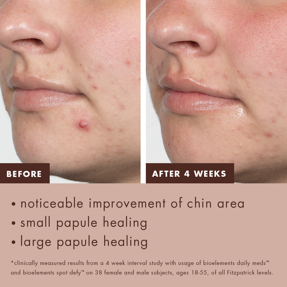 acne – Bioelements