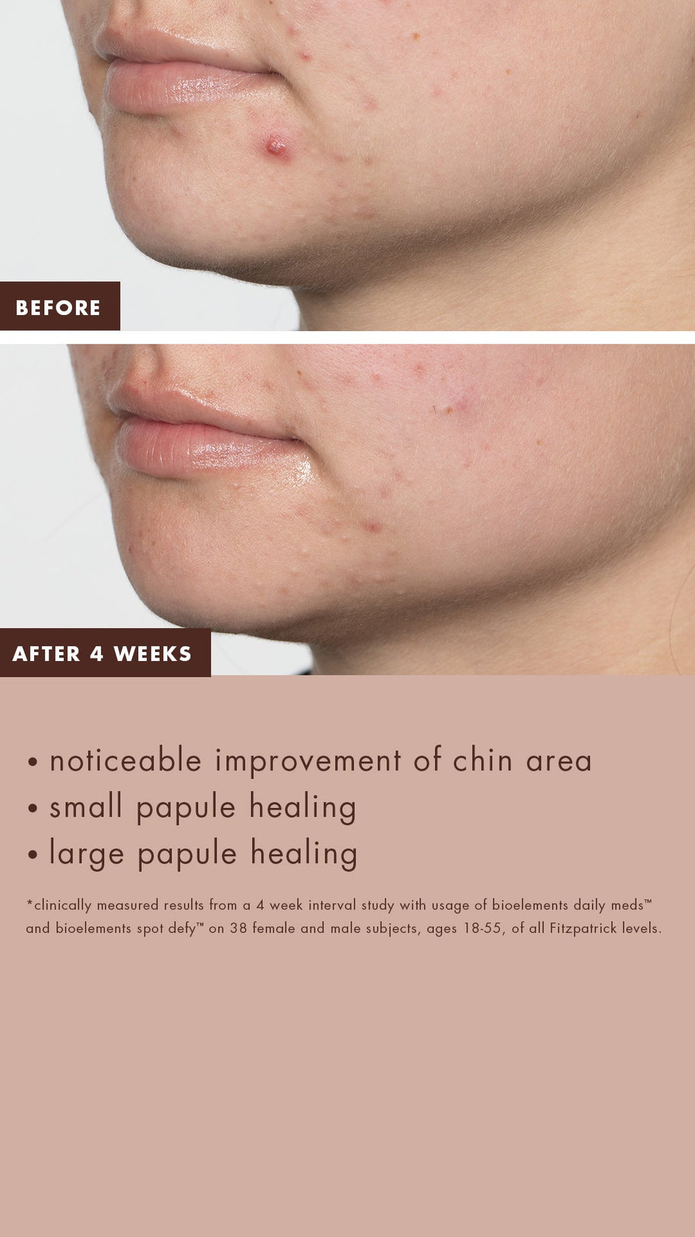 acne – Bioelements