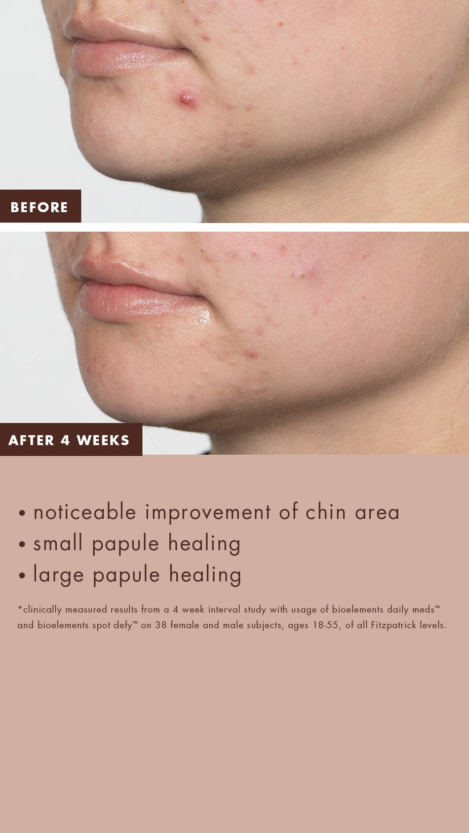 acne – Bioelements