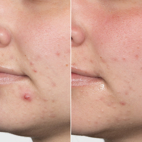 Bioelements Before + After Results