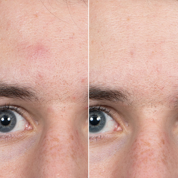 Bioelements Before + After Results