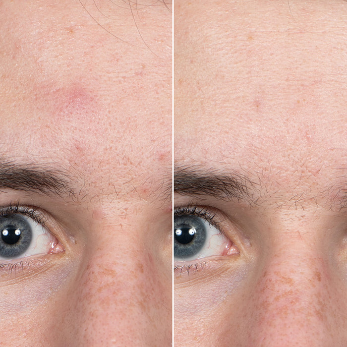 Bioelements Before + After Results